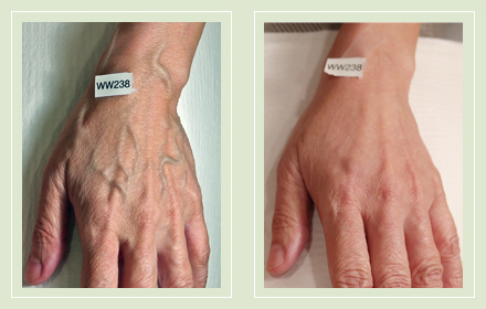 Hands – The Vein Treatment Center