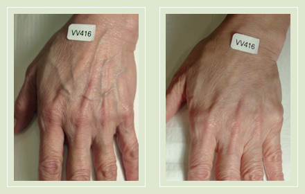 Hands – The Vein Treatment Center