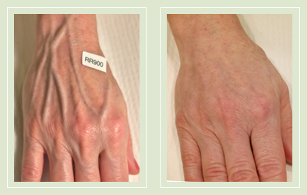 Hands – The Vein Treatment Center