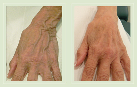 Hands – The Vein Treatment Center