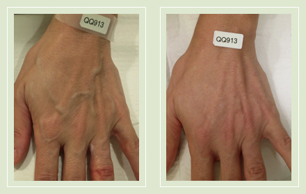 Hands – The Vein Treatment Center