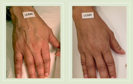 Hands – The Vein Treatment Center