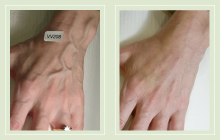Hands – The Vein Treatment Center