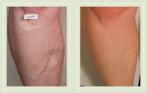 Mini-Phlebectomy – The Vein Treatment Center