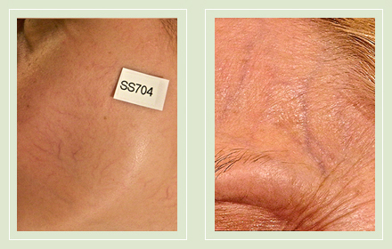 Facial Veins – The Vein Treatment Center